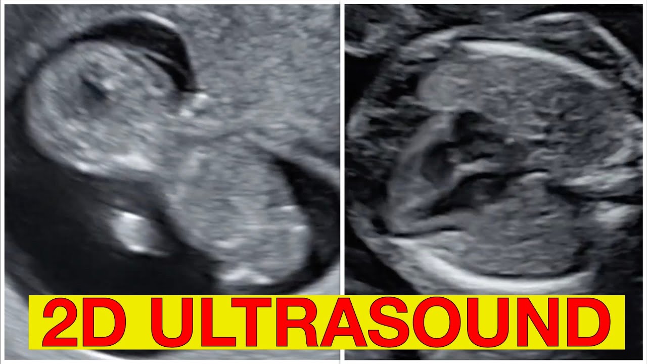 2D Pregnancy Ultrasound - YouTube