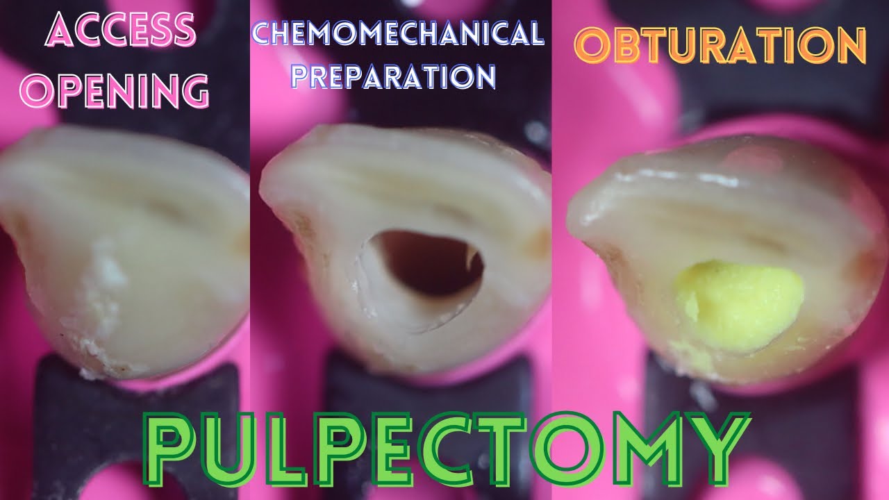 Access Opening ⚪️ Chemomechanical Preparation 🟢 Obturation 🟡 Pulpectomy ...
