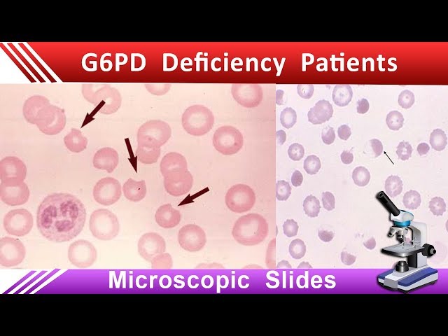 G6pd Deficiency Smear