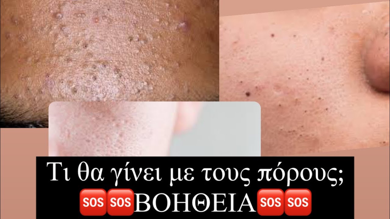 ΒΟΗΘΕΙΑ 🆘 ΤΙ ΓΙΝΕΤΑΙ ΜΕ ΤΟΥΣ ΠΟΡΟΥΣ 🆘 - YouTube