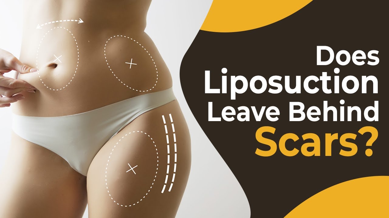 Does Liposuction Leave Scars