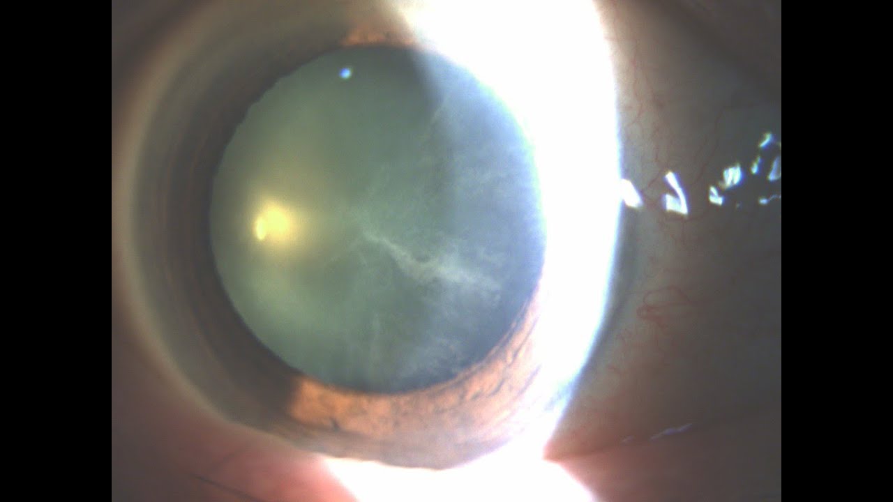 cataract surgery after ACG (acute angle closure, IOP over 50mmHg) - YouTube