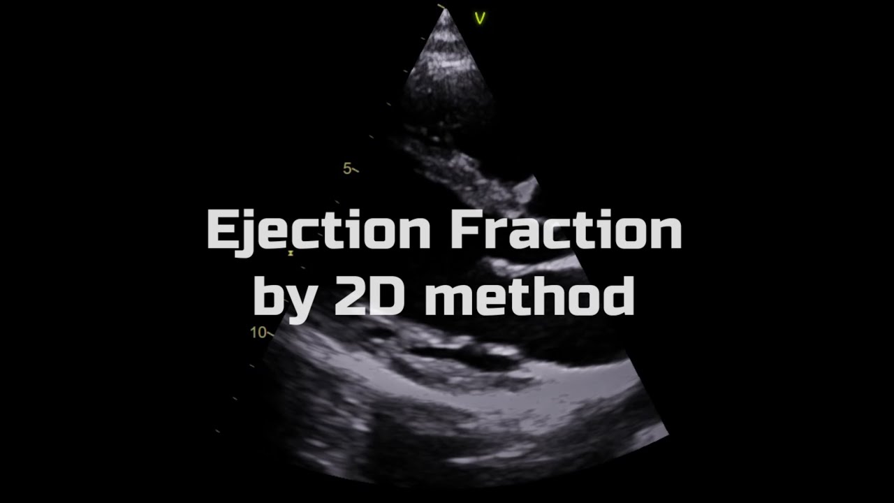 Ejection Fraction by 2D method - YouTube