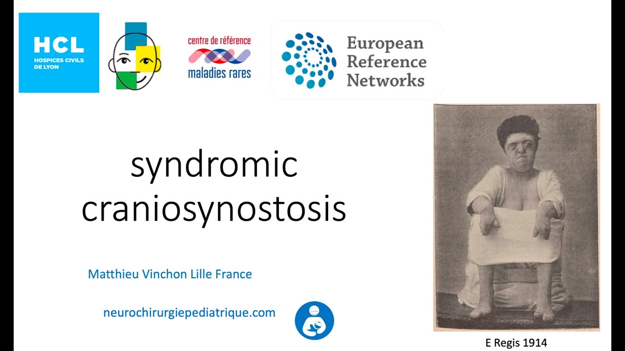 syndromic synostoses - YouTube