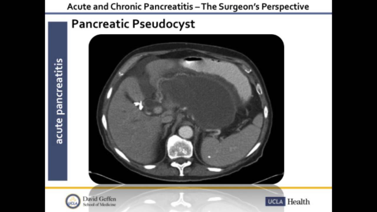 Acute and Chronic Pancreatitis | O. Joe Hines, MD | UCLA Digestive ...