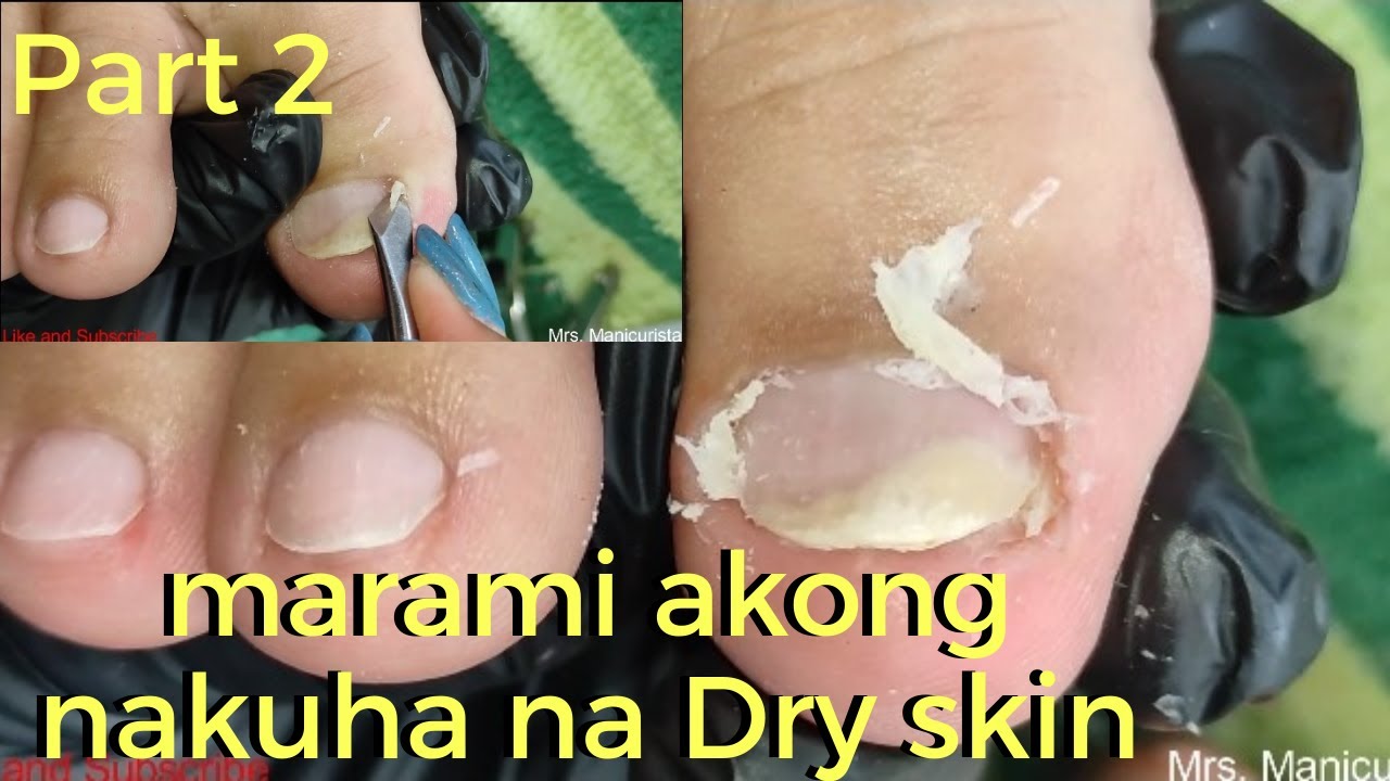 Vlog 622|Dry Skin/Ingrown Removal| PEDICURE 522 - YouTube