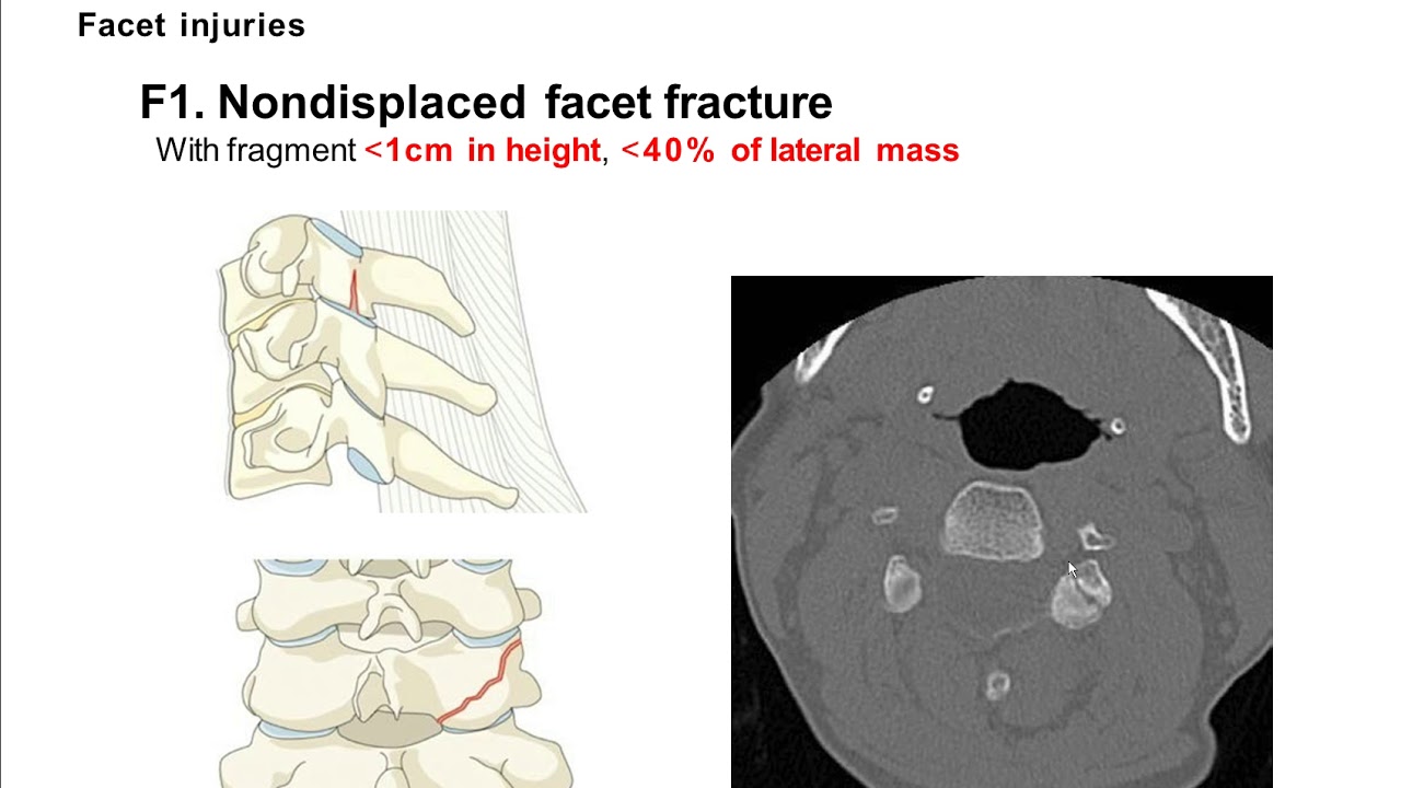 Spinal Fracture AO Classification - YouTube