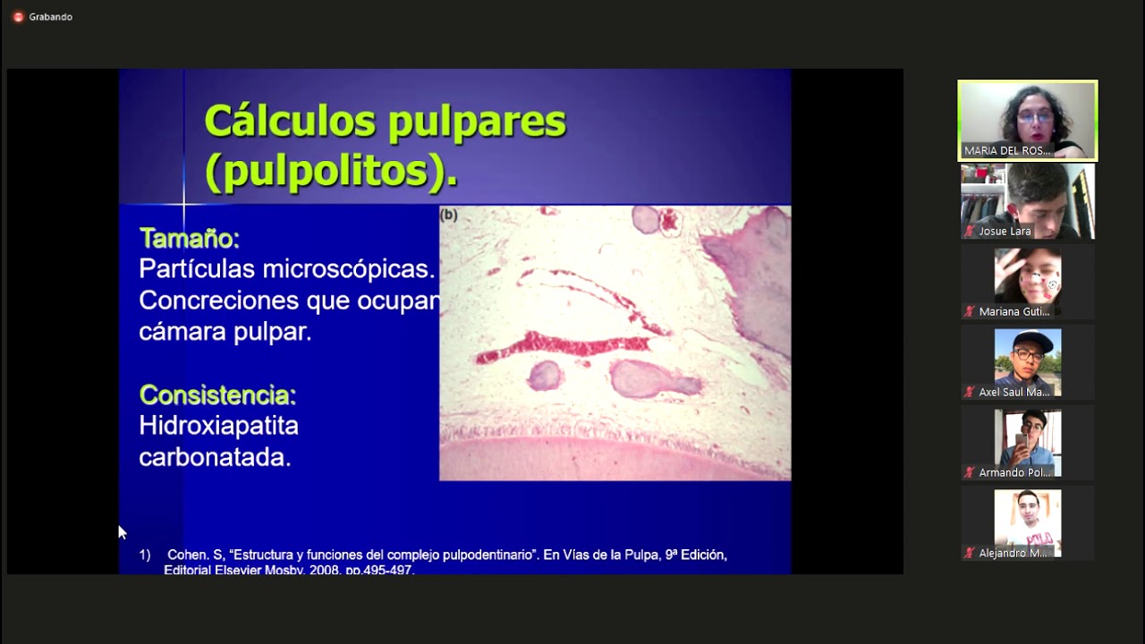 Pulposis, pulpolitos, degeneración cálcica, calcificaciones ...