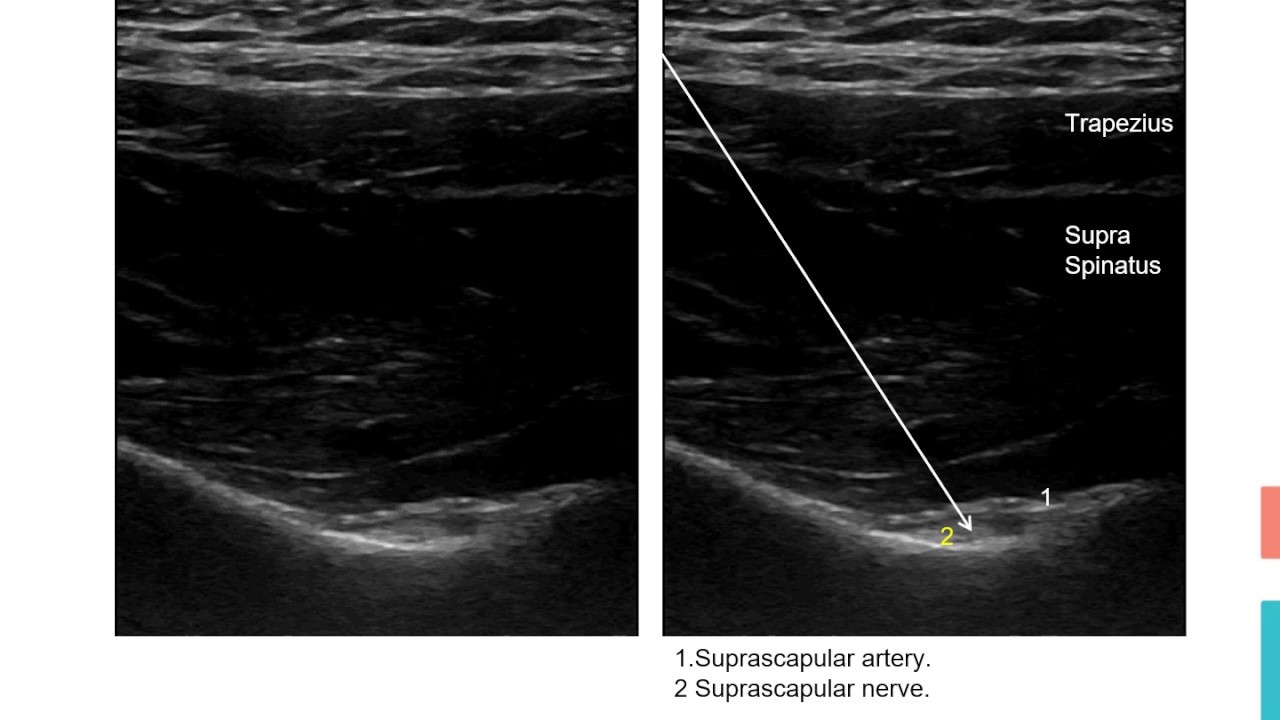 Suprascapular nerve block - YouTube