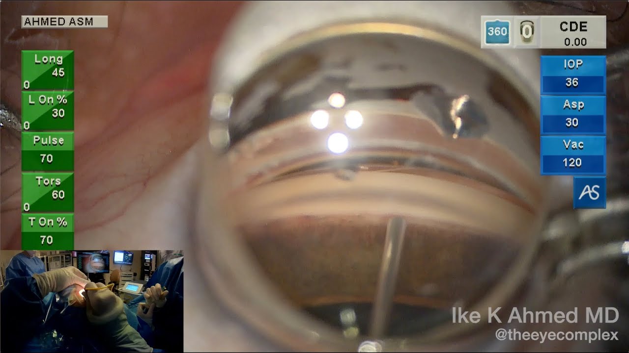 Elios Excimer Laser Trabeculostomy MIGS Procedure for Glaucoma - YouTube