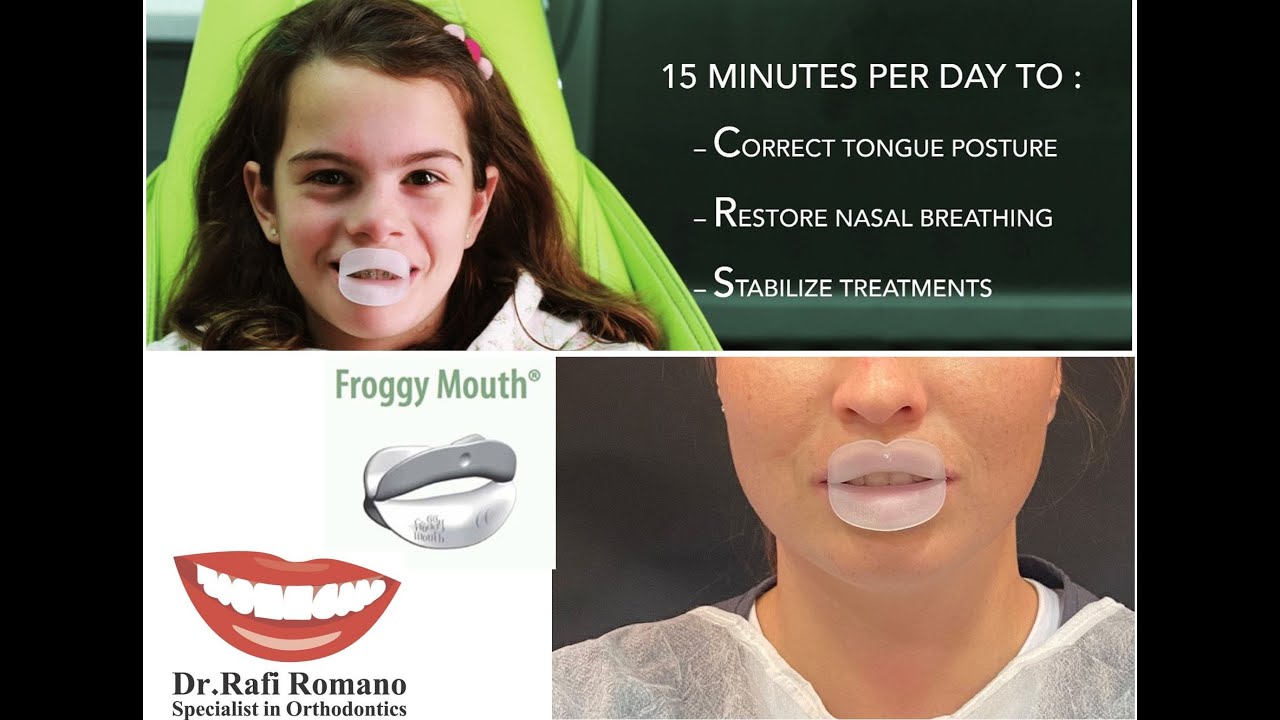 Dr Rafi Romano Froggy mouth - YouTube
