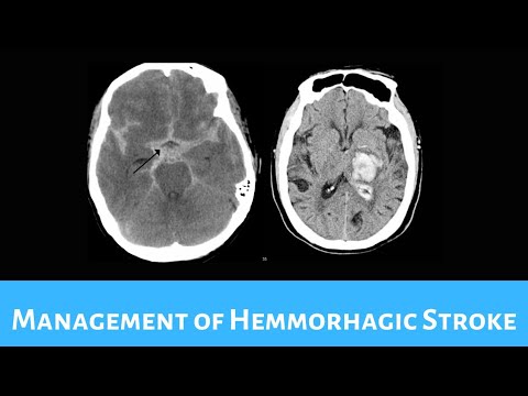 Management of Hemorrhagic Stroke - YouTube
