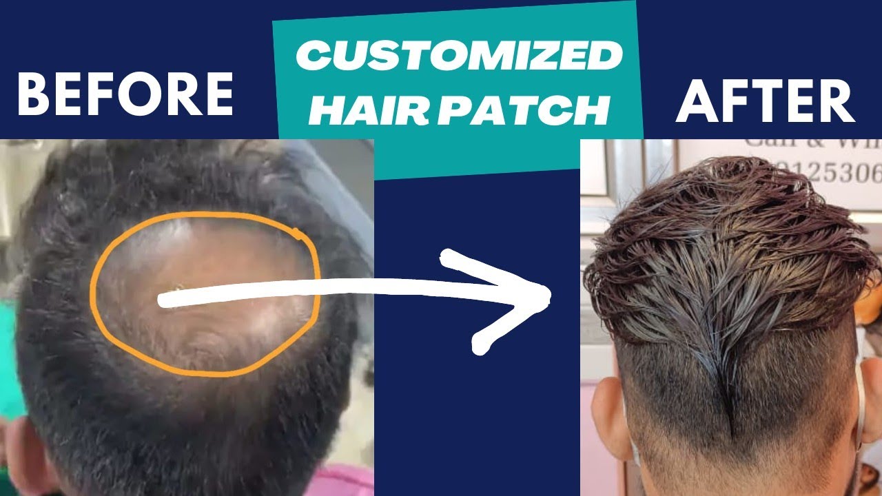customized hair patch | hair patches for men | kanpur hair patch ...