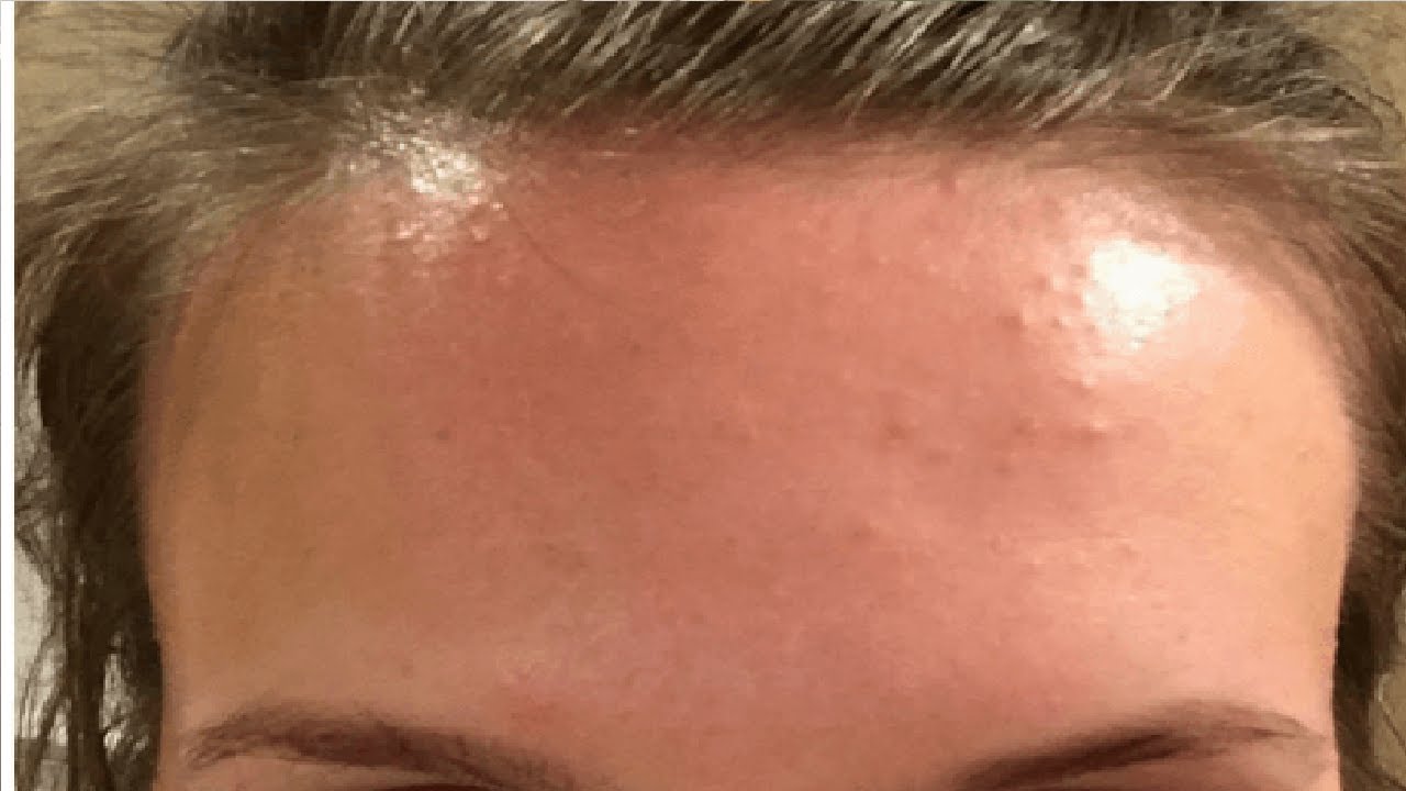 how to get rid of textured skin on forehead - YouTube