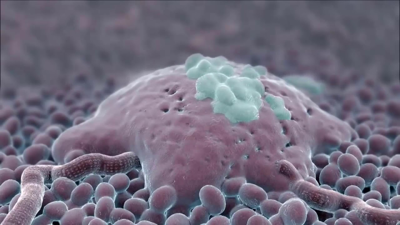 Cos'è il carcinoma a cellule squamose in situ - YouTube