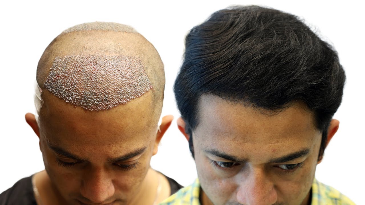 Hairline & Crown Transplant Result | New Roots Hair Transplant | - YouTube