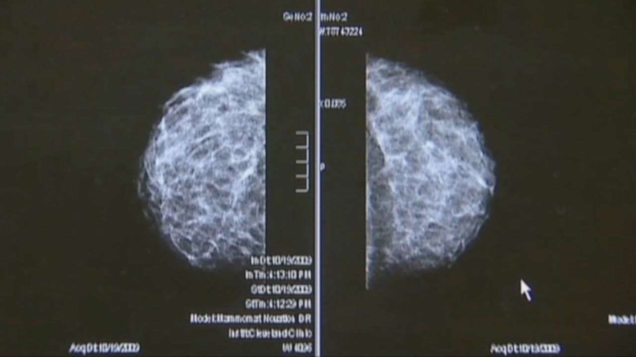 Doctors Advocates Praise Lowering Recommended Age Of Mammograms To Age