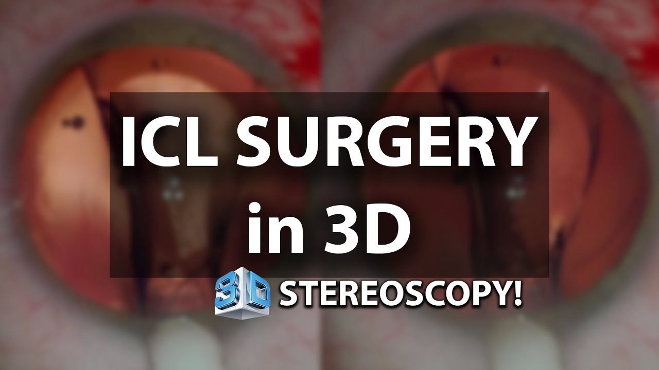 ICL Surgery in 3D (Stereoscopic 3D/Magic Eye) - YouTube