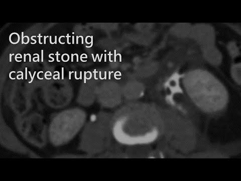 Abdominal case review - Obstructing renal stone with calyceal rupture ...