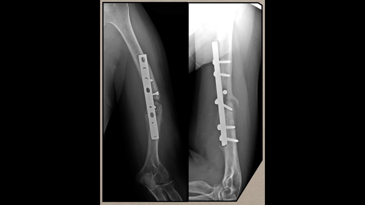 Infected Non Union Humerus- Ilizarov method - YouTube