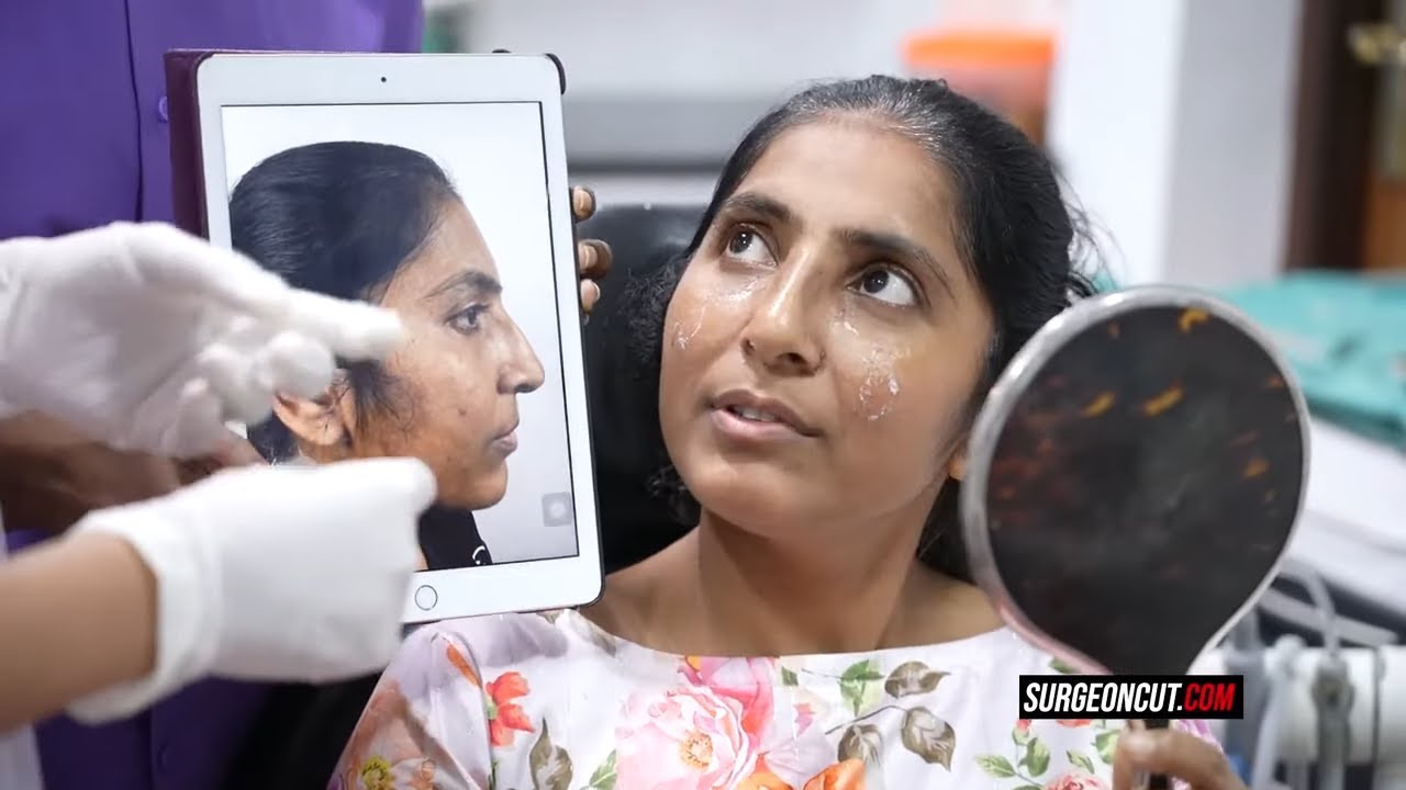 Long Nose Women Rhinoplasty | Indian Nosejob Amazing Transformation ...