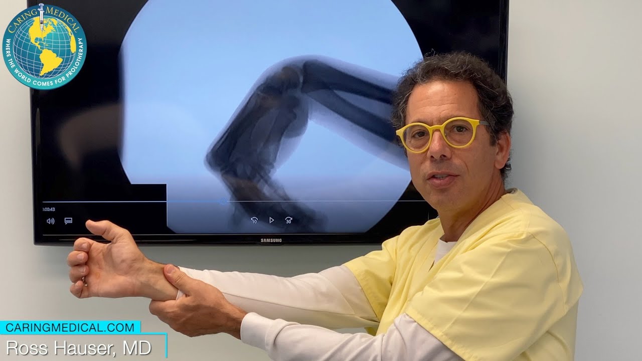 Distal radioulnar instability seen on DMX - Prolotherapy case review ...