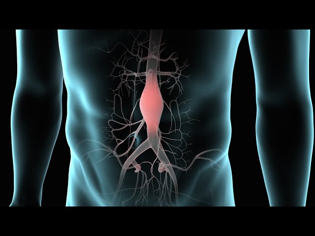 Abdominal Aortic Aneurysm Repair