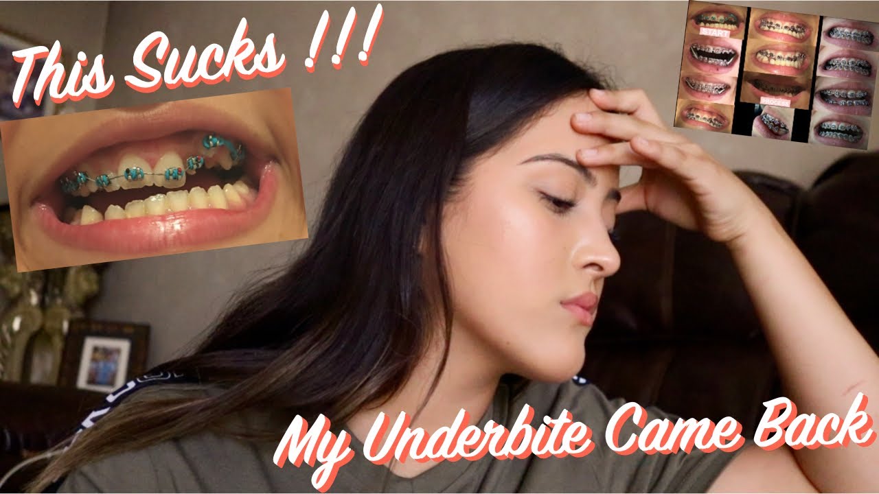 MY UNDERBITE CAME BACK!!! | Braces Update #8 | - YouTube