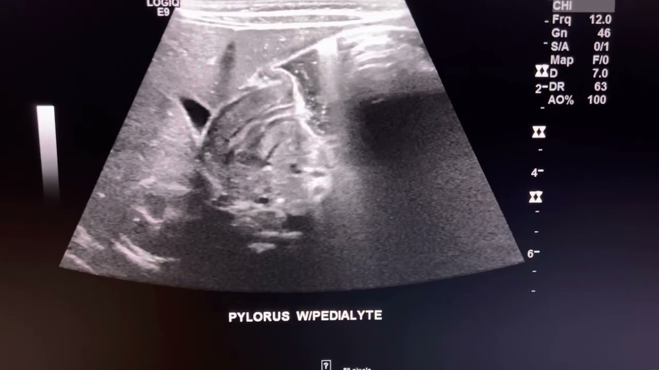 Pylorus Ultrasound