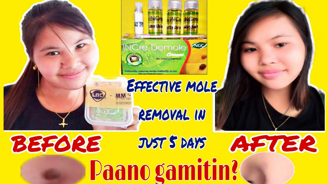 MOLE AND WARTS REMOVAL CREAM / Mabisang Pangtanggal ng Nunal - YouTube