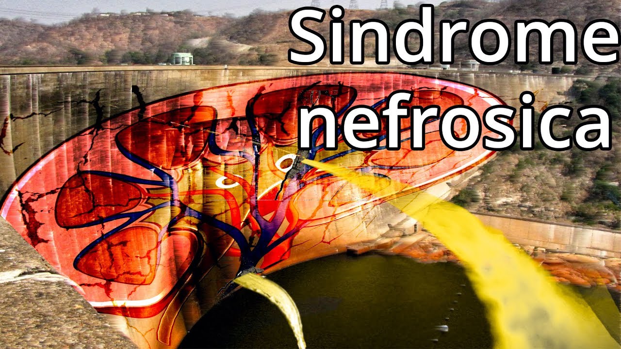 SINDROME NEFROSICA - - Spiegazione - YouTube