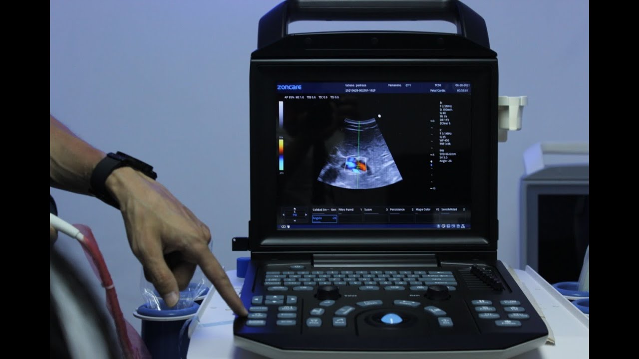 Ultrasonido Zoncare M5 Color Doppler - YouTube