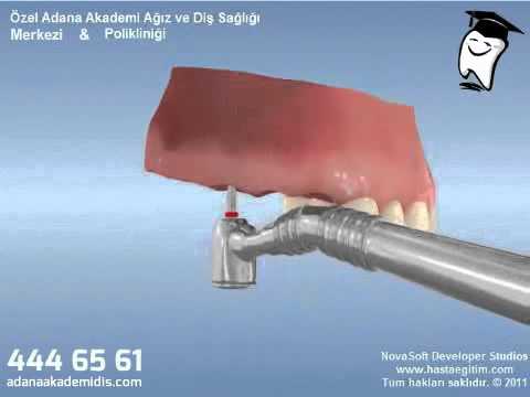 24 Kısmi diş eksikliğinin implant üstü sabit kronlarla giderilmesi