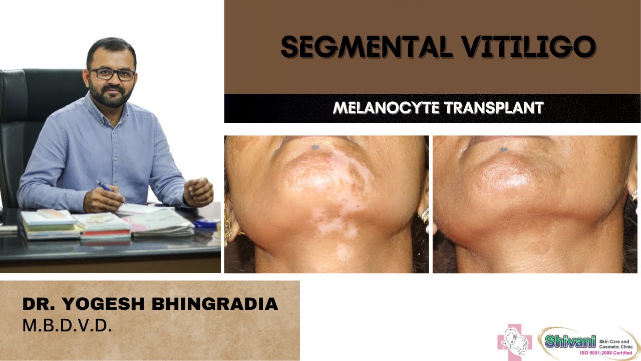 Segmental vitiligo | Melanocyte transplant surgery | Dr Yogesh ...