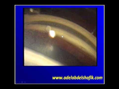 Gonioscopy Lecture part 3 - YouTube