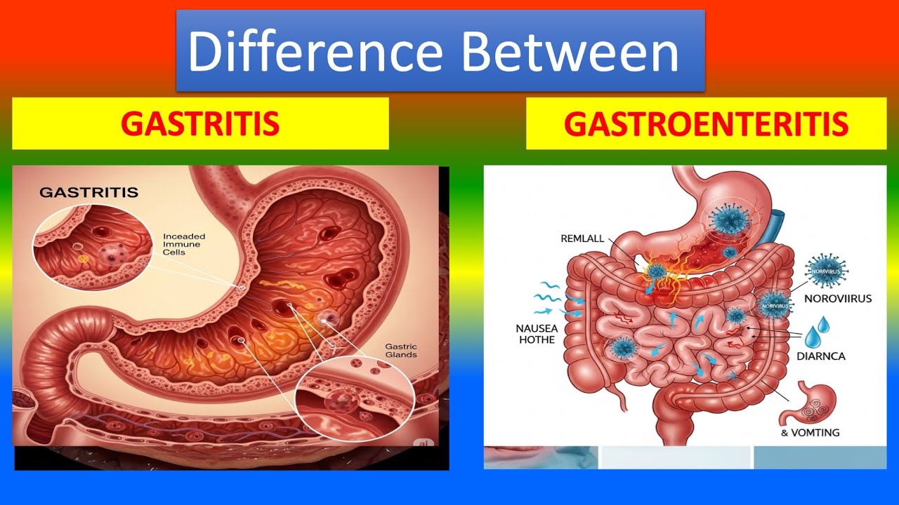 Differences between Gastritis and Gastroenteritis: - YouTube