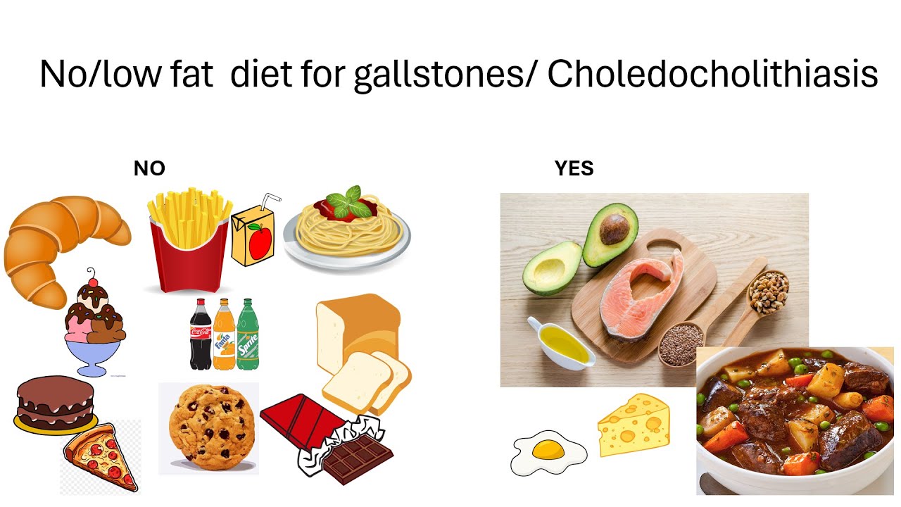 No fat/low fat diet for gallstones/ Choledocholithiasis, not such a ...