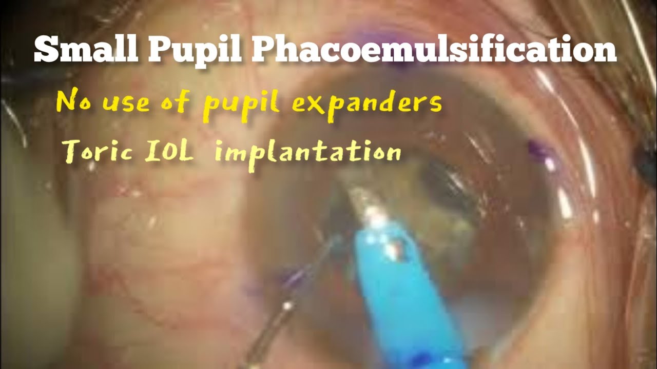 Small pupil phacoemulsification and toric IOL implantation without ...