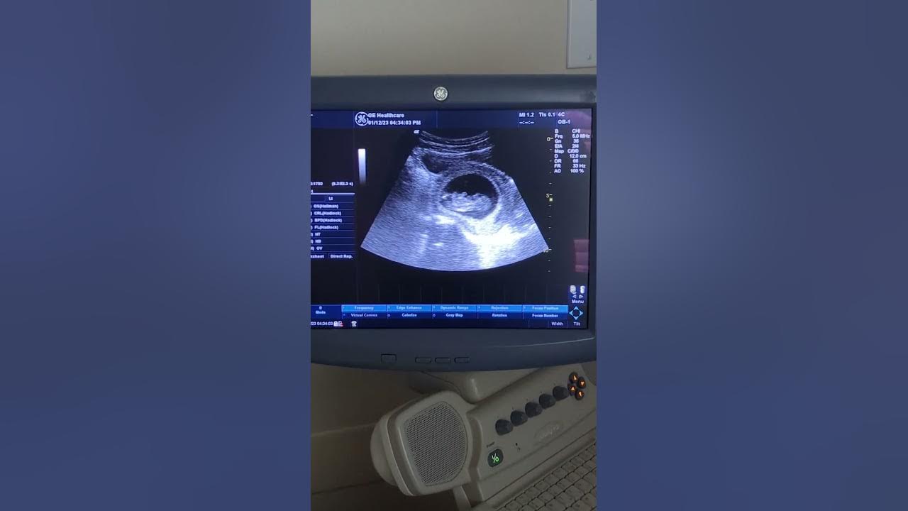 Baby At 11 Weeks Pregnant YouTube baby-at-11-weeks-pregnant-youtube