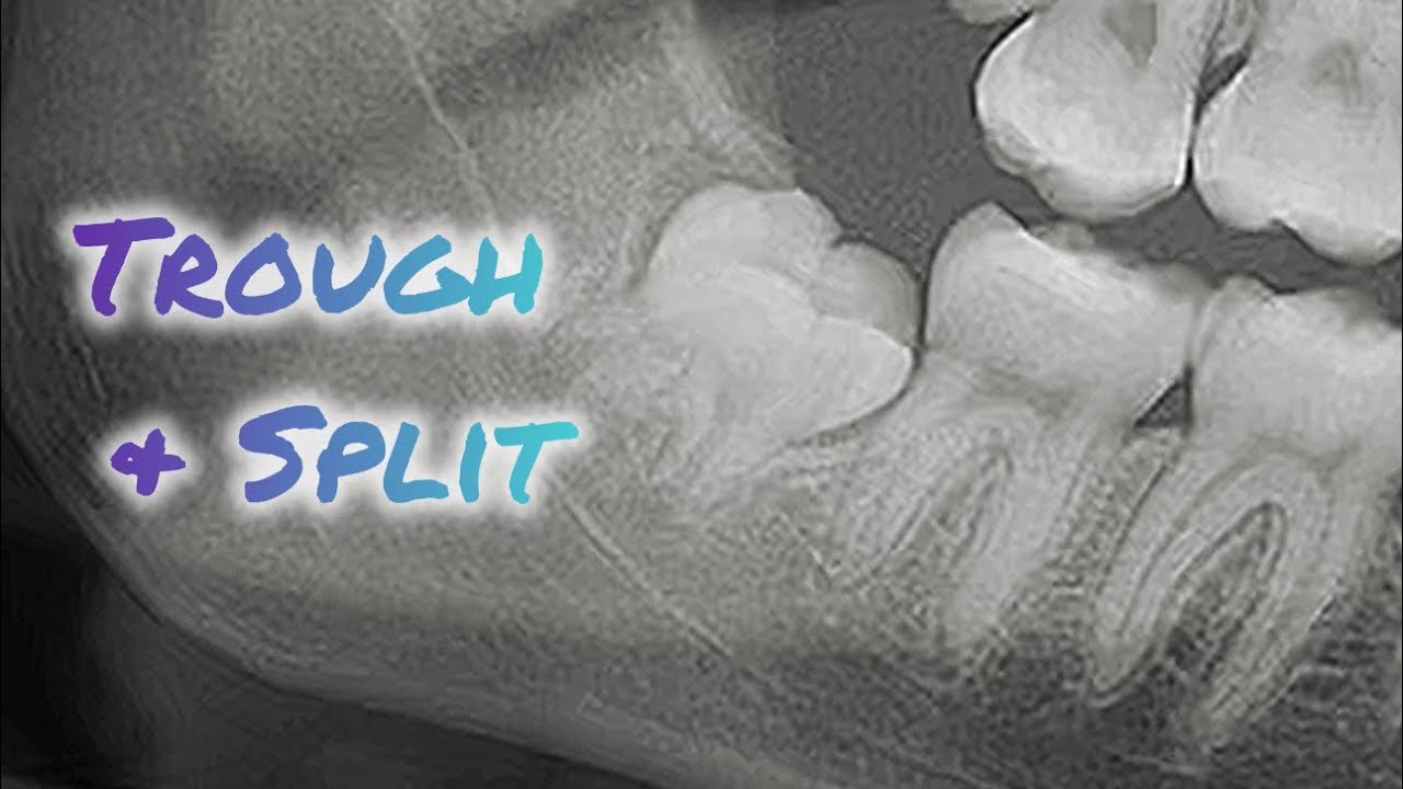 Trough and Split to Remove this Wisdom Tooth - YouTube