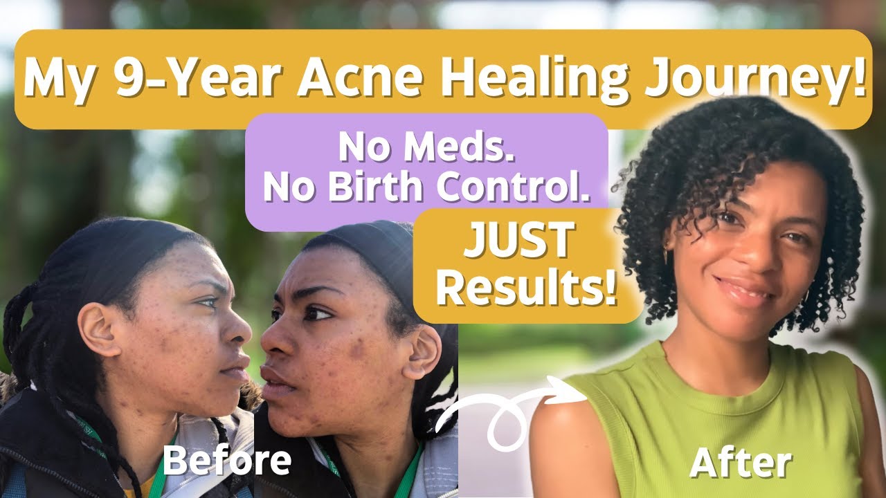 Acne for 9 Years--Here's What Id Do Differently For Quicker Results ...