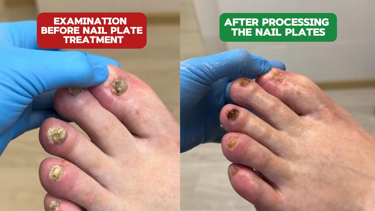 How to restore toenails? Examination, cleaning, preparation for ...