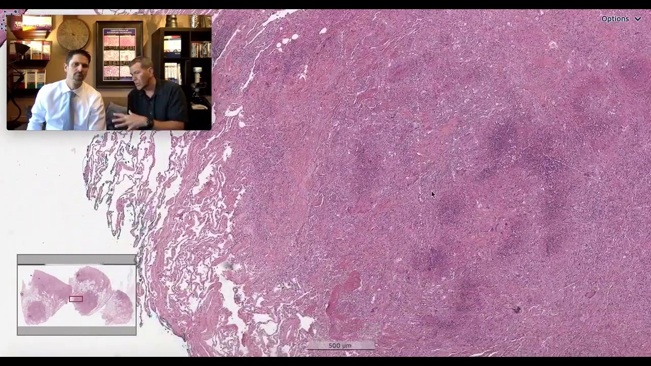 Pattern 5 - Granulomatosis with Polyangiitis (GPA, aka Wegener) - YouTube