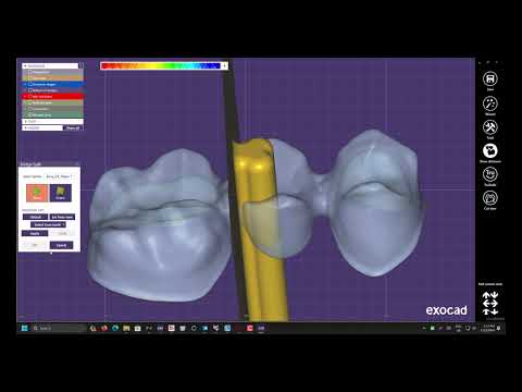 How to split a framework bridge in exocad - YouTube