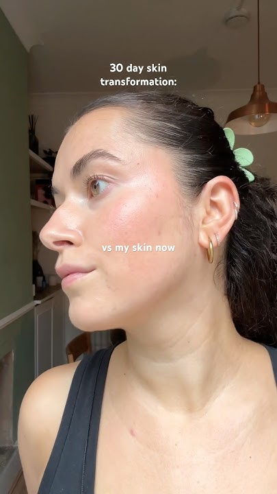30 day skin transformation #acneproneskin #skintransformation #skinblogger #skincarejourney # ...