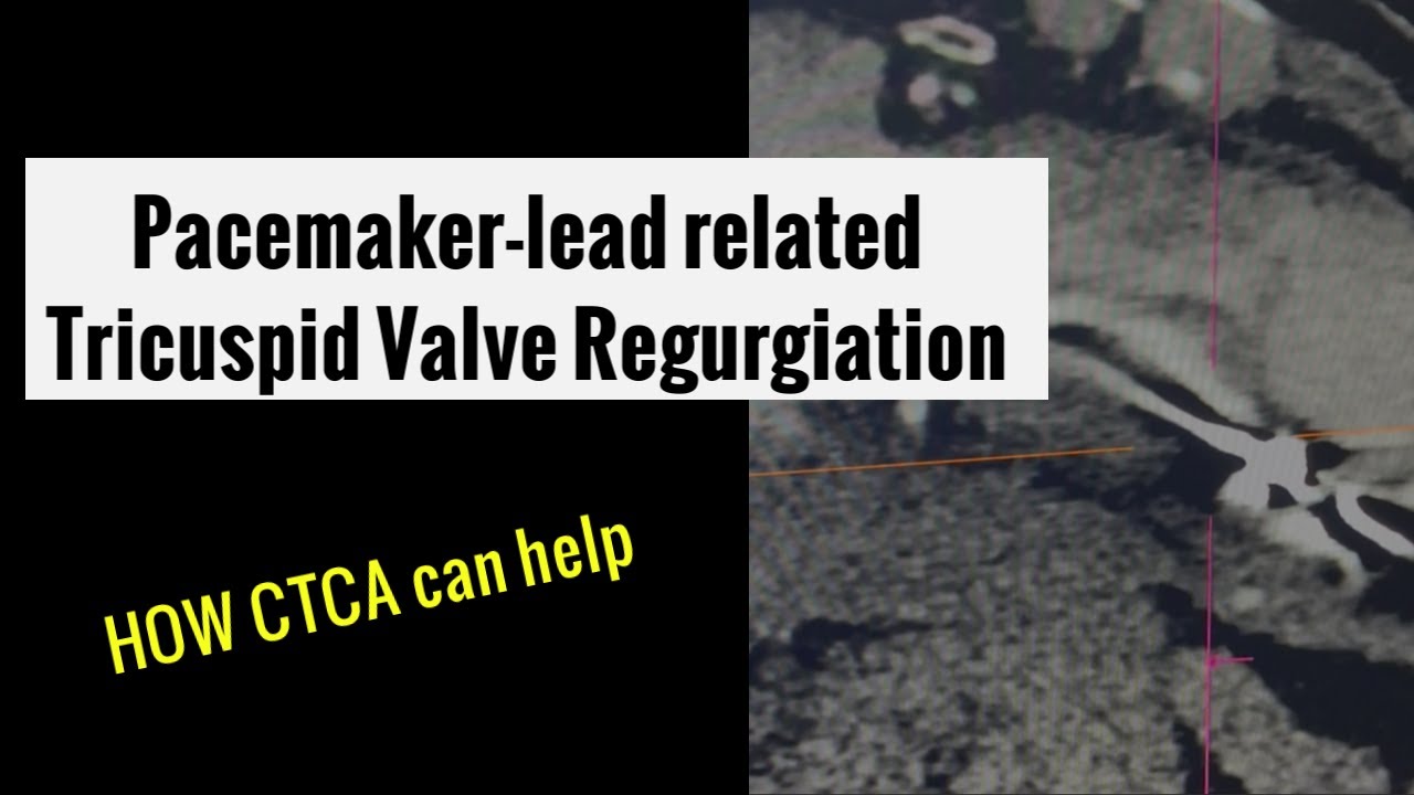 CT Coronary Angiogram and pacemaker-lead related tricuspid valve ...