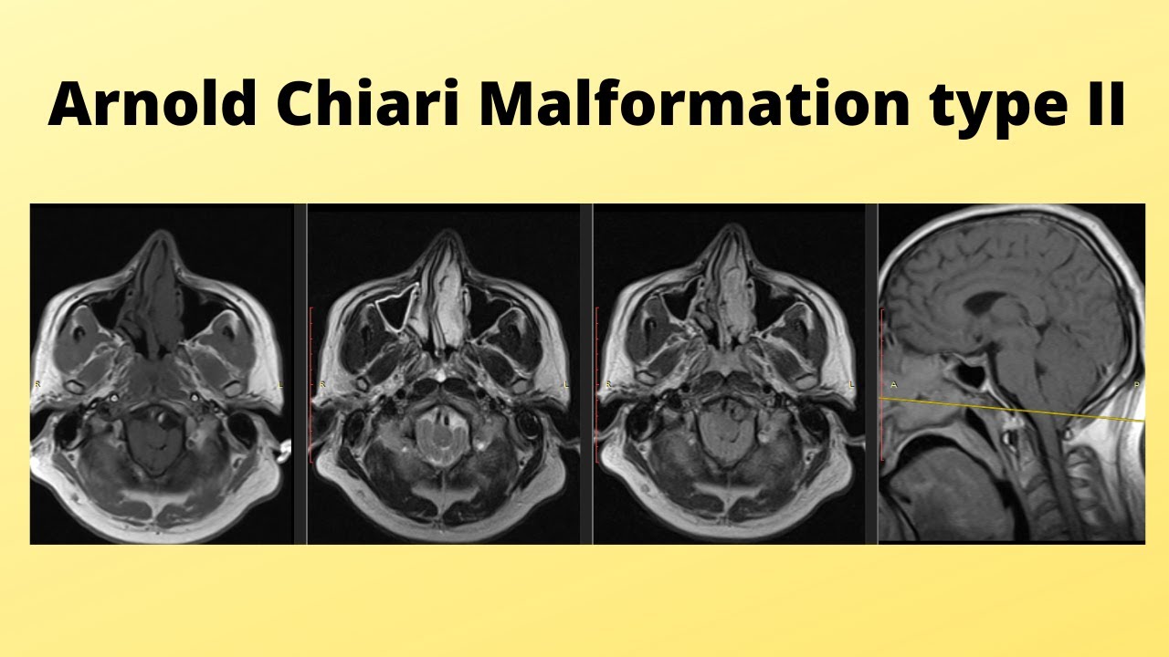 Arnold chiari malformation TYPE II - YouTube