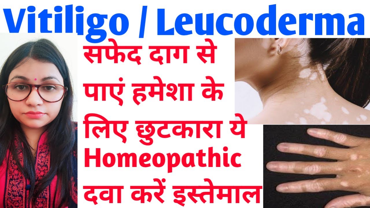 Leucoderma Homeopathic Medicine | सफेद दाग के इलाज |Vitiligo ...