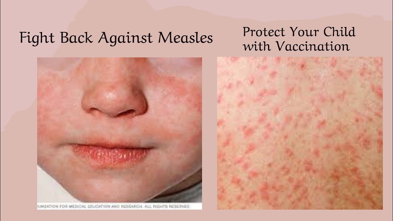 Measles Making a Measly Comeback? Here's How to Fight Back! - YouTube