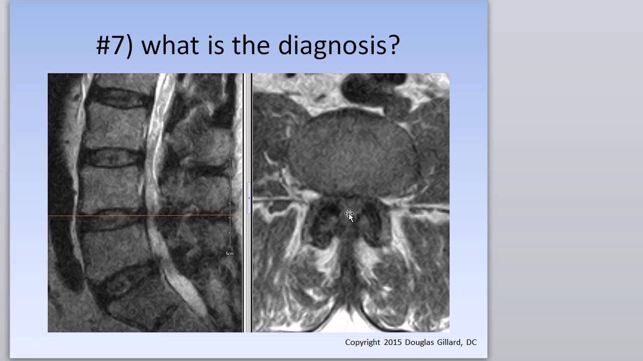 Differential Diagnosis II (Lumbar Spine Disease) Summer-2015-Edited ...